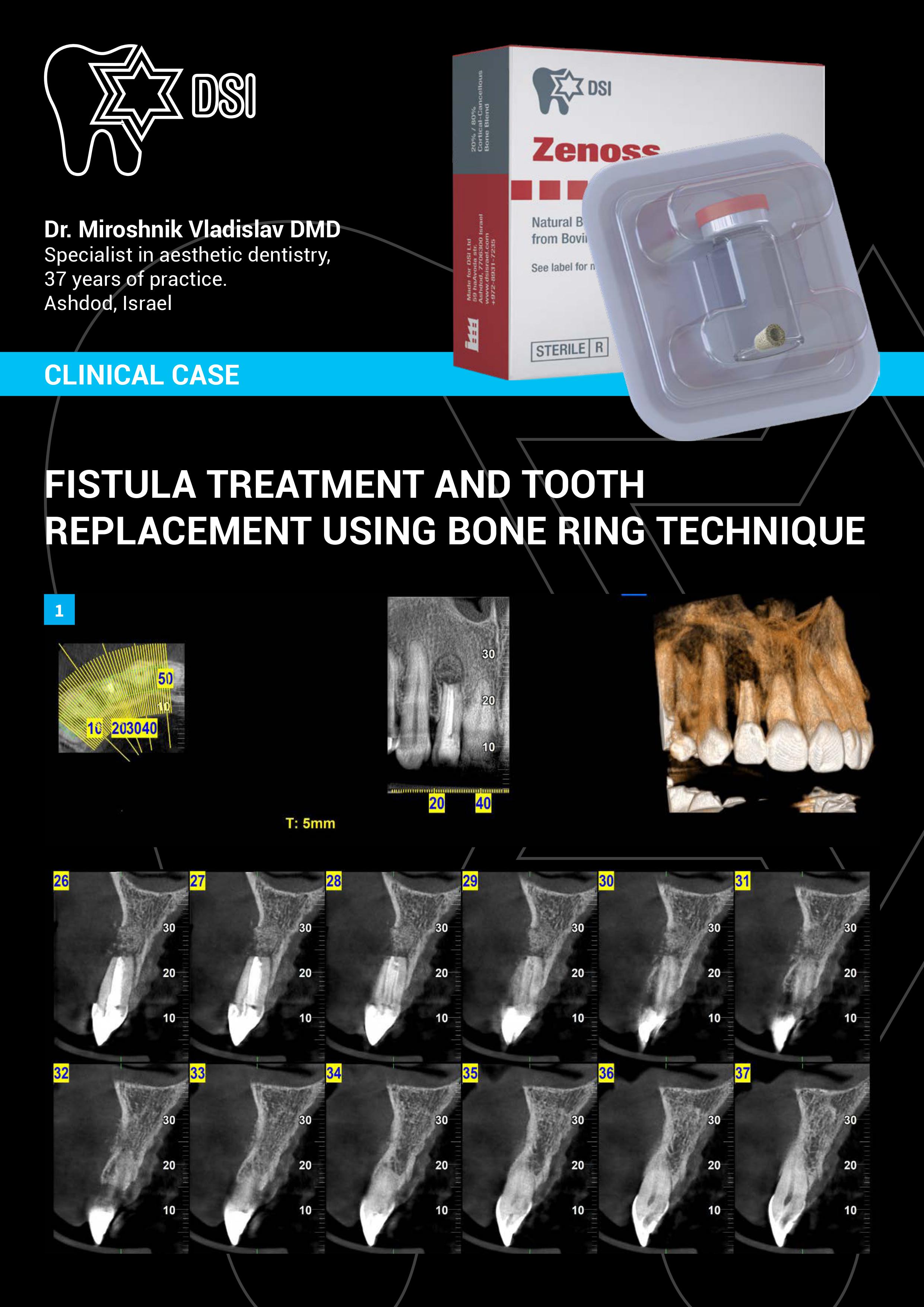 Case Study: Fistula treatment and tooth replacement using bone ring ...