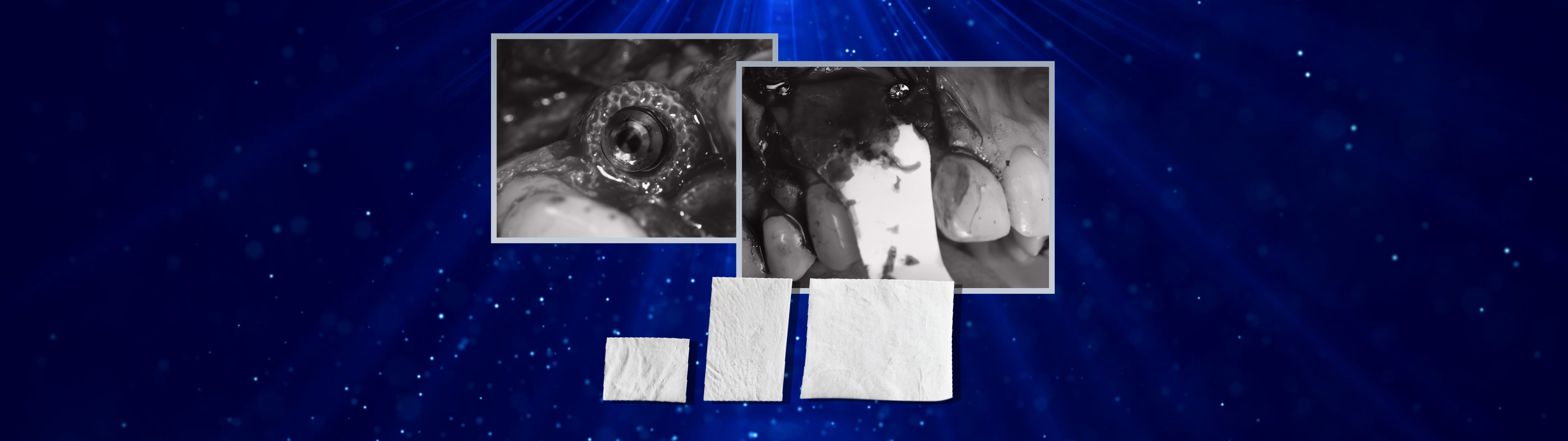 Case Study: Fistula treatment and tooth replacement using bone ring ...