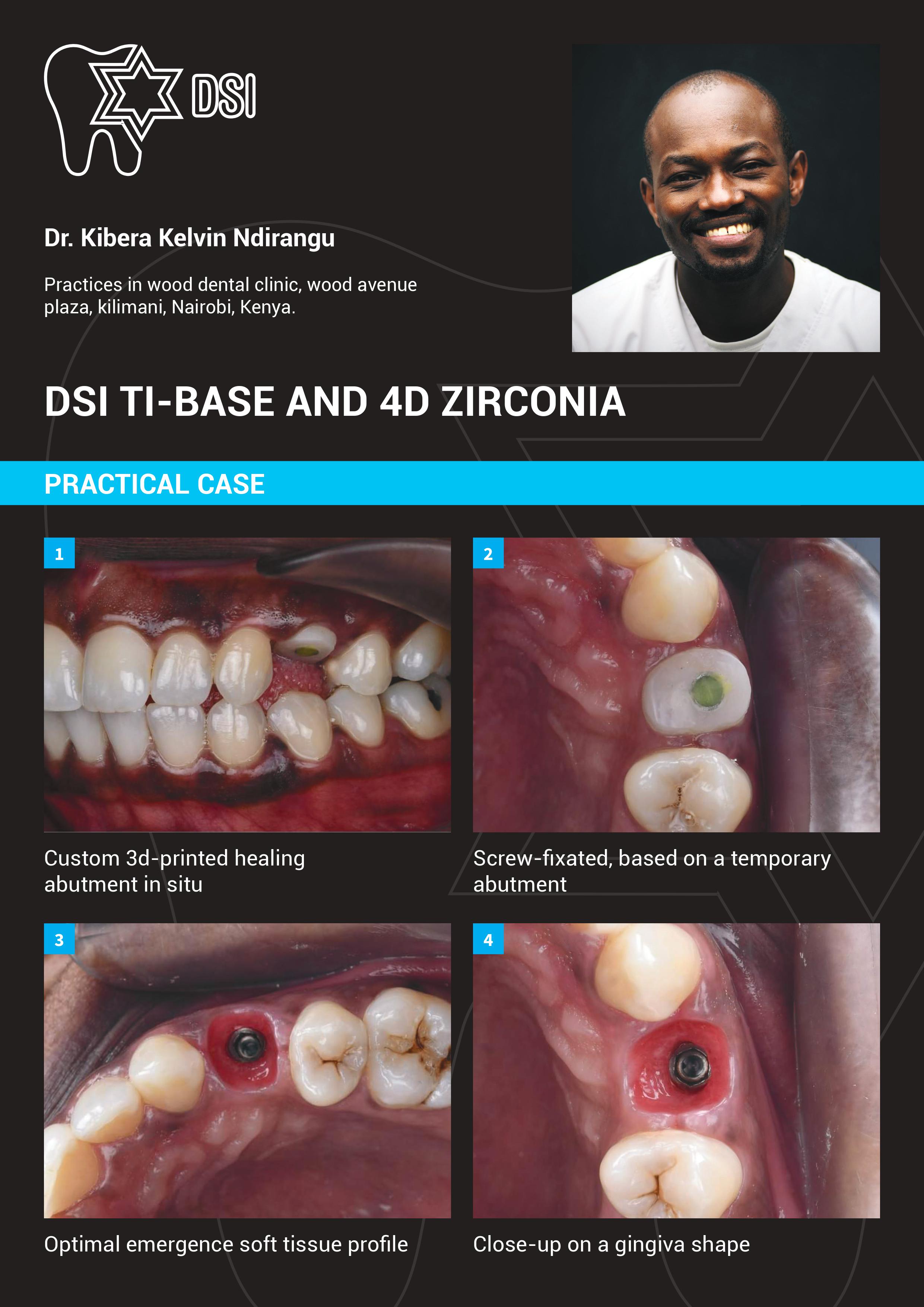 Case Study: Practical case with DSI Ti Base CAD-CAM Libraries | DSI