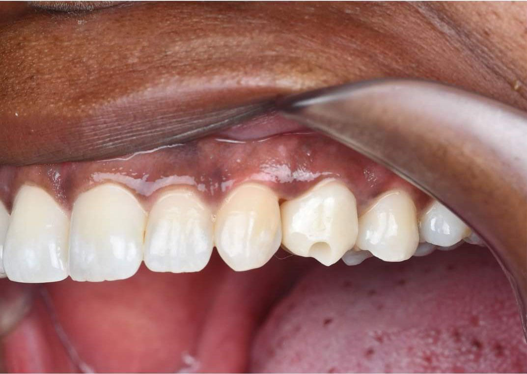 Case Study: Practical case with DSI Ti Base CAD-CAM Libraries | DSI