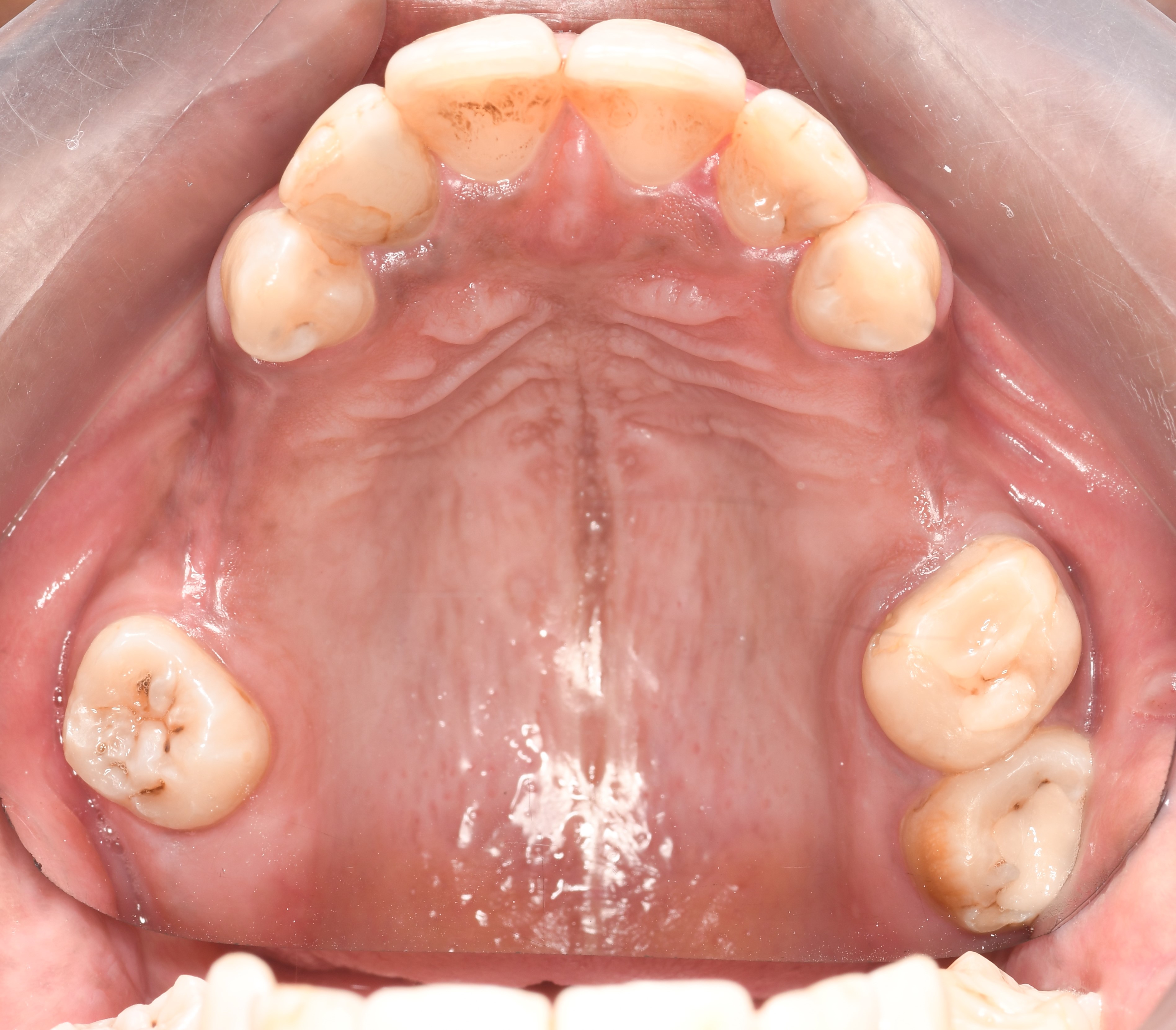 Case Study: Implants and Veneers Procedure. Anterior&Posterior ...