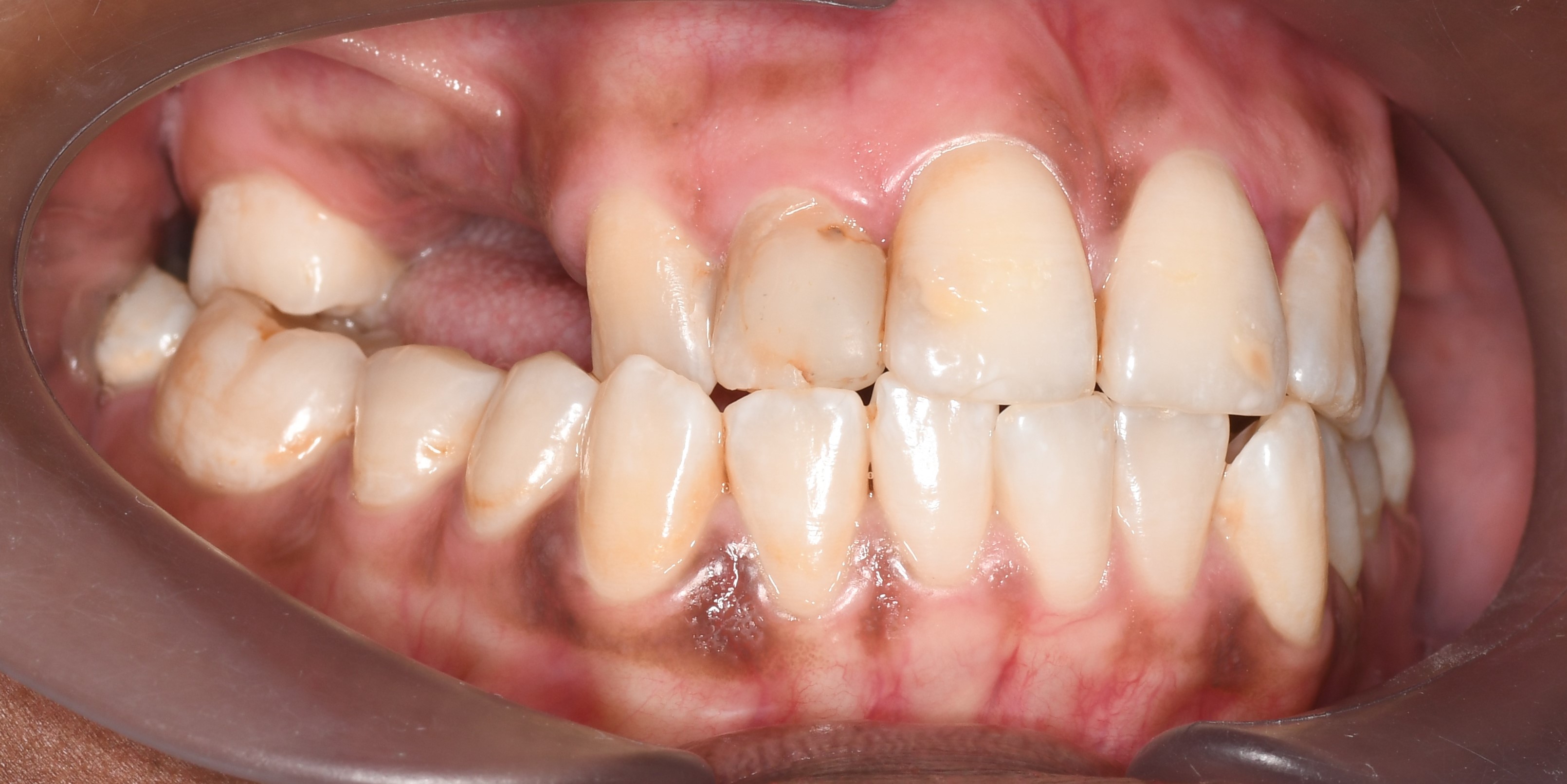 Case Study: Implants and Veneers Procedure. Anterior&Posterior ...