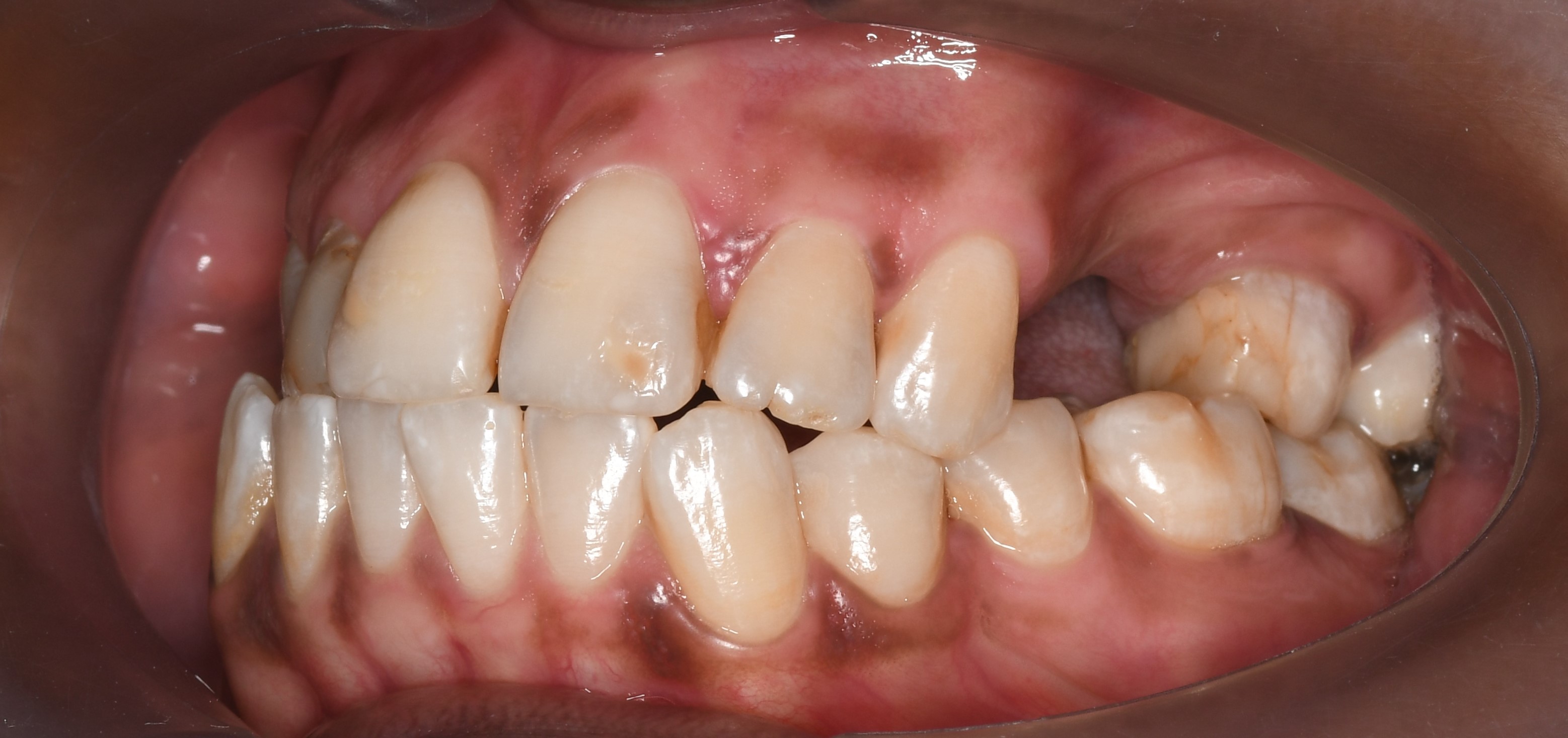 Case Study: Implants and Veneers Procedure. Anterior&Posterior ...