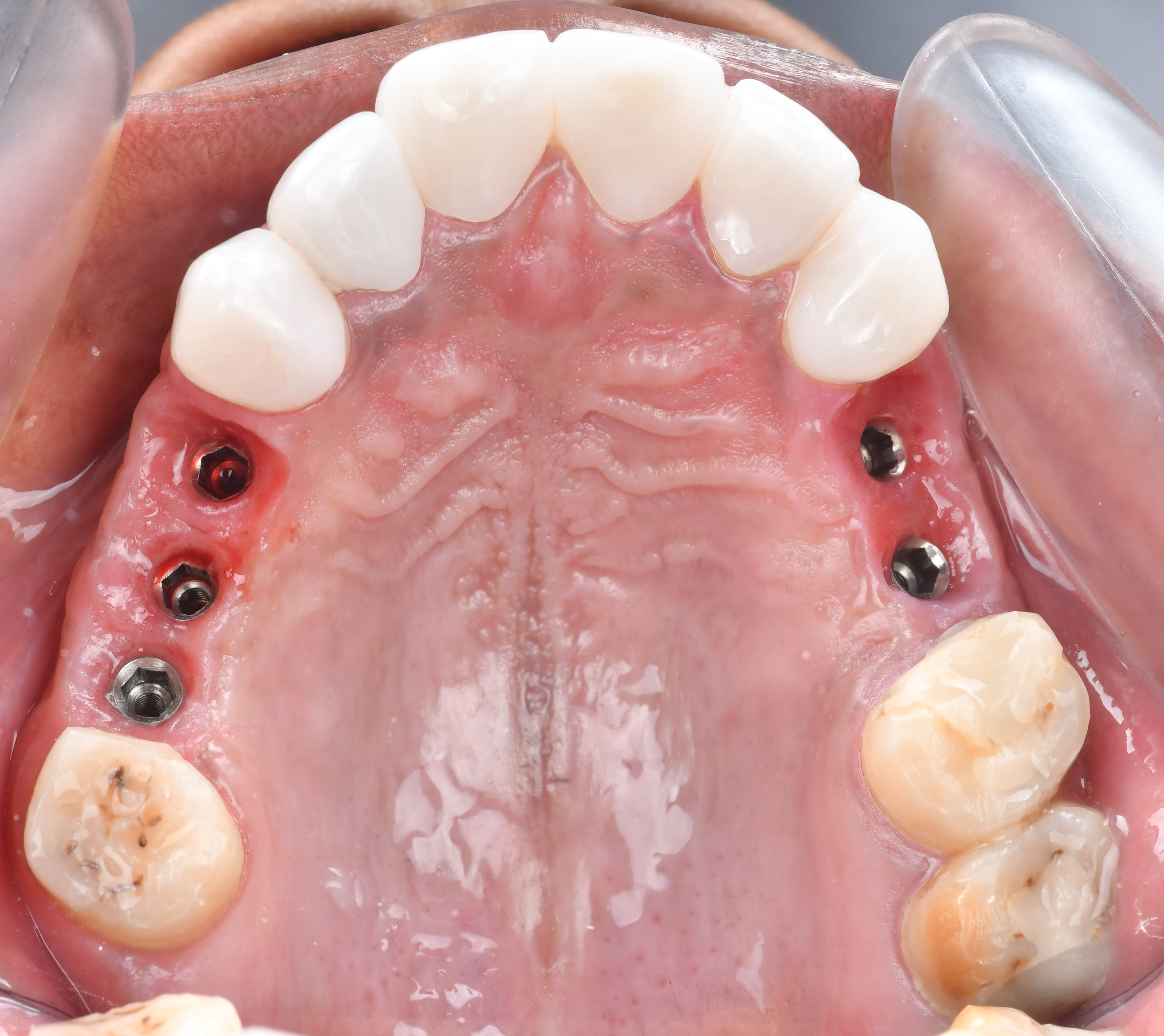 Case Study: Implants and Veneers Procedure. Anterior&Posterior ...