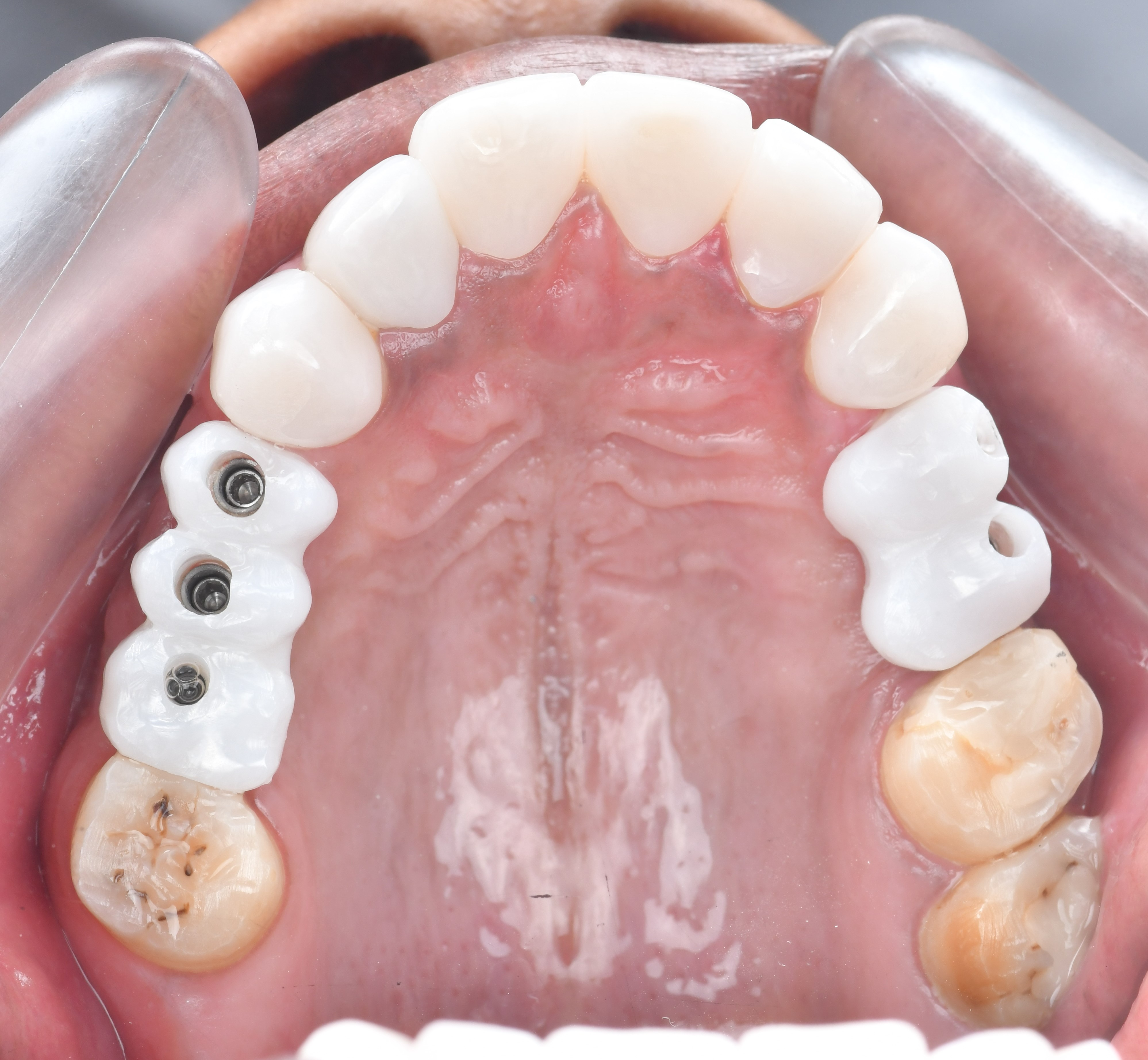 Case Study: Implants and Veneers Procedure. Anterior&Posterior ...