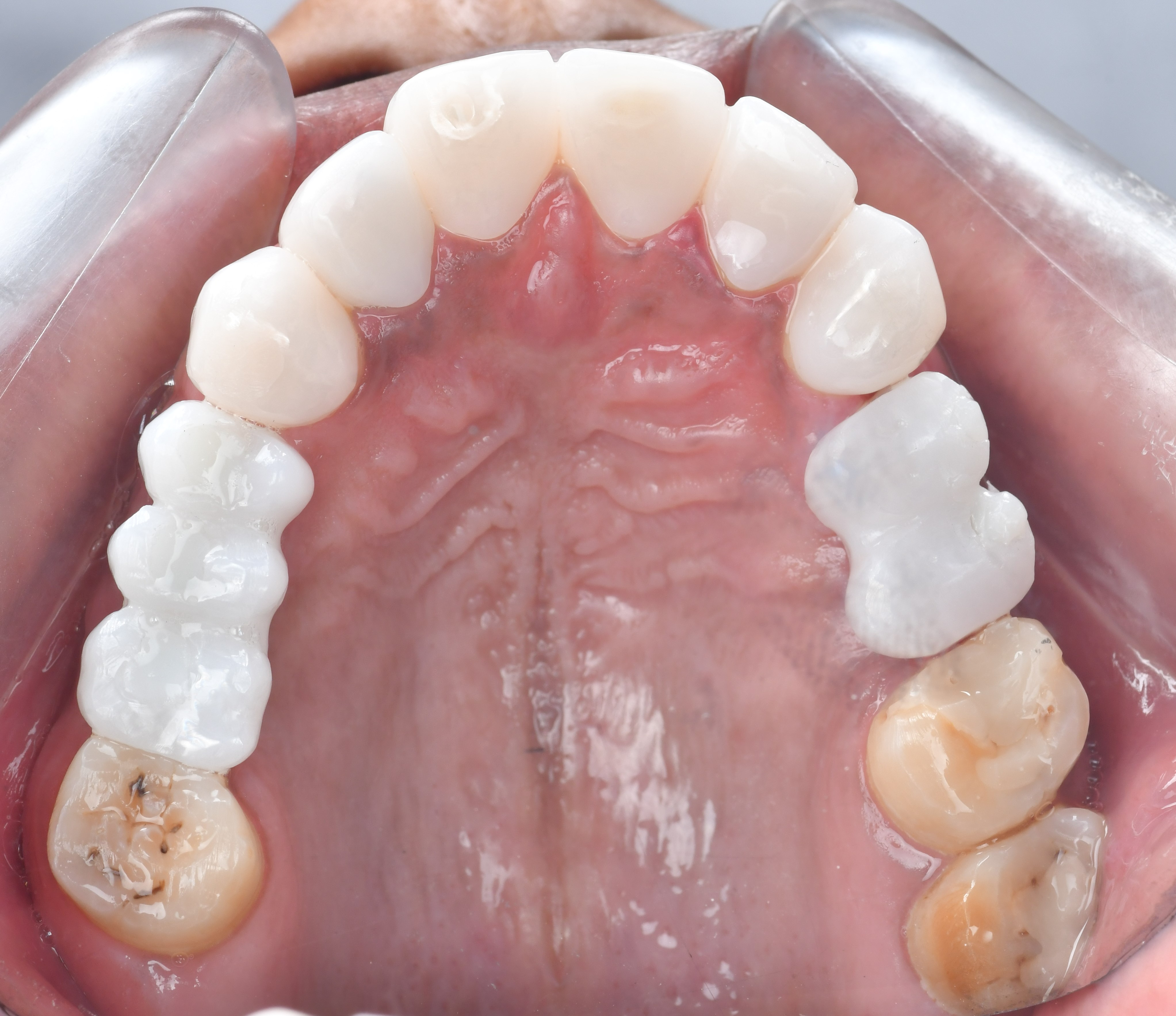 Case Study: Implants and Veneers Procedure. Anterior&Posterior ...