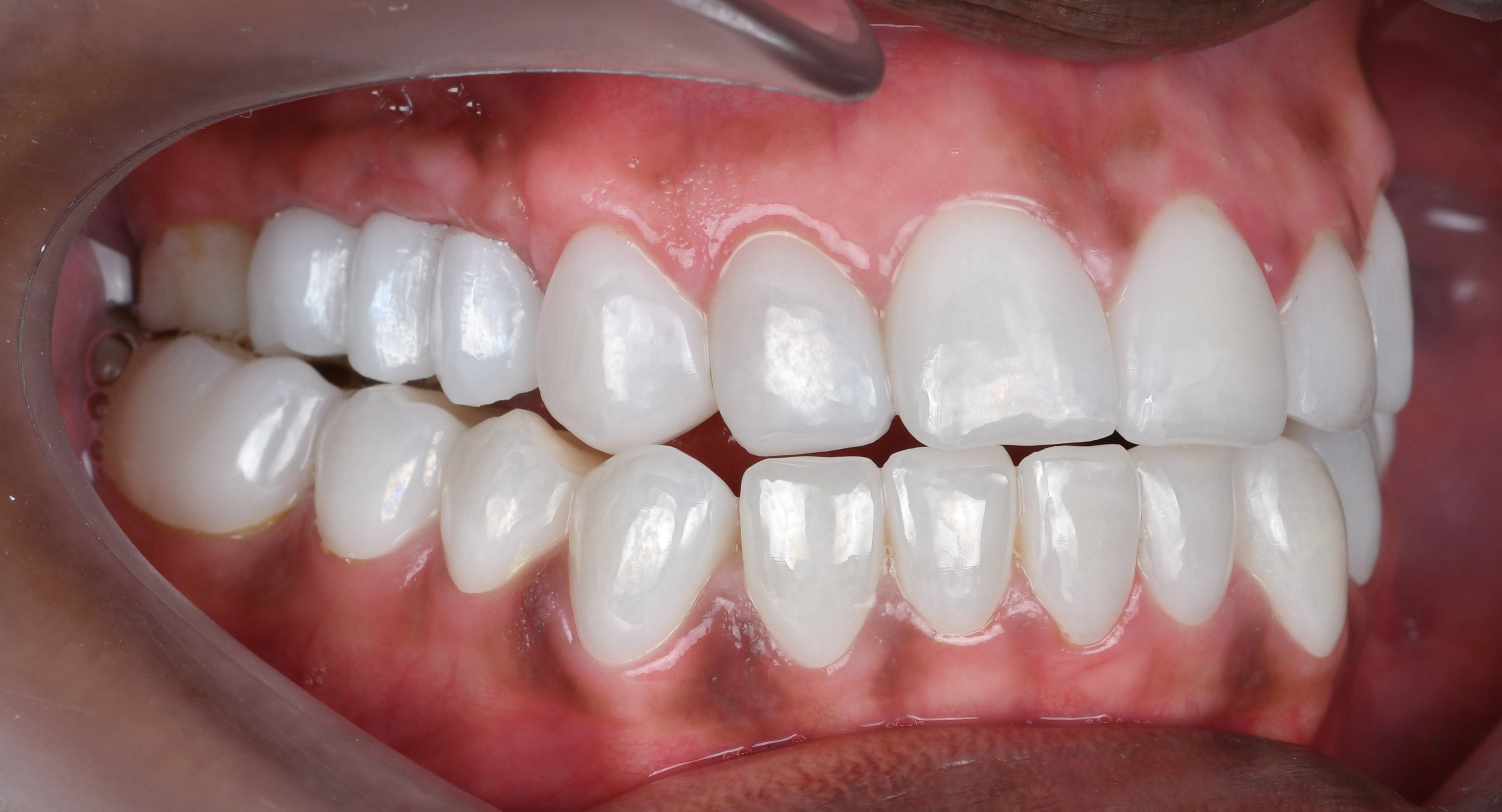 Case Study: Implants and Veneers Procedure. Anterior&Posterior ...