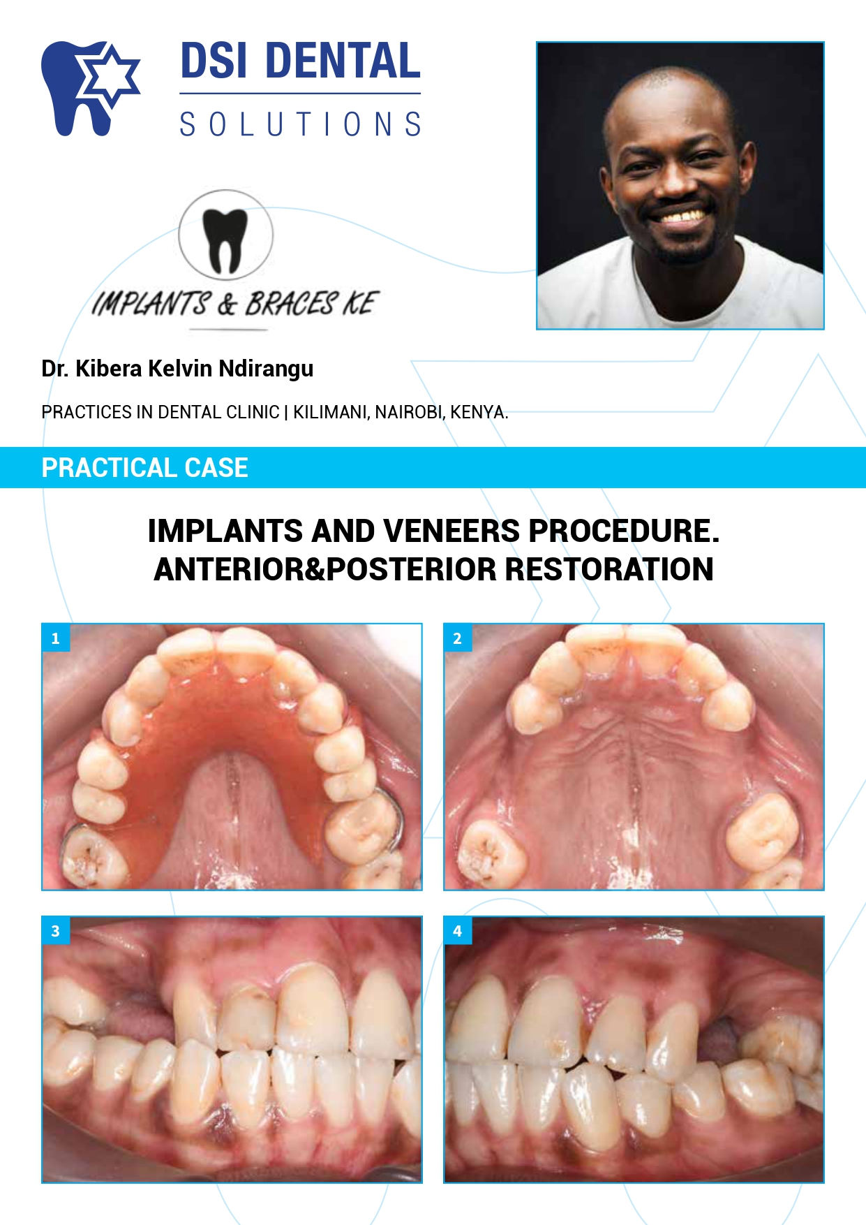 Case Study: Implants and Veneers Procedure. Anterior&Posterior ...