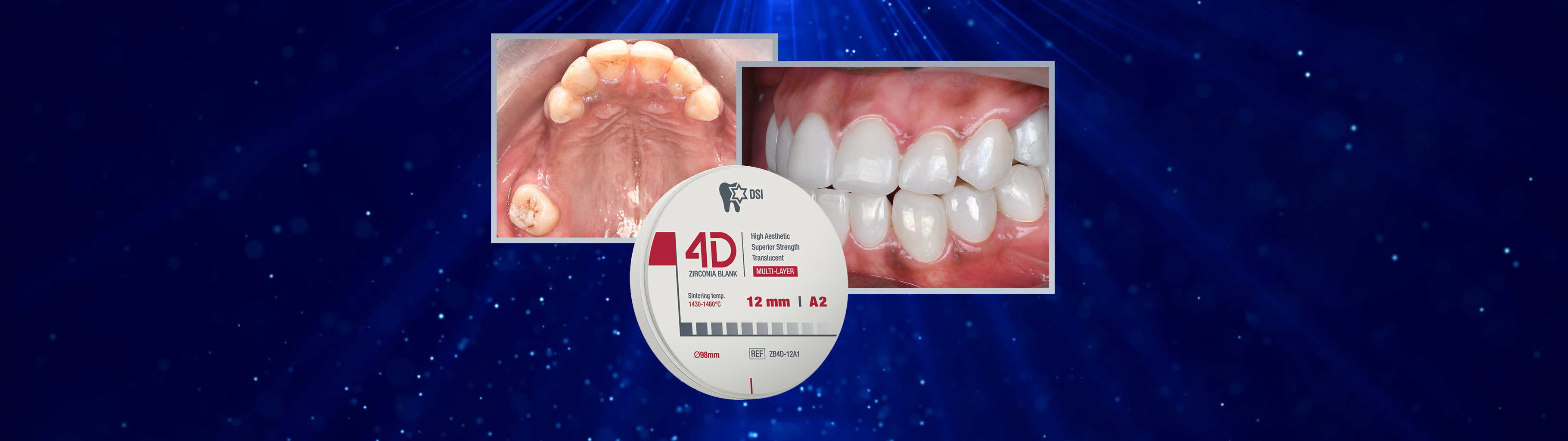 Case Study: Implants and Veneers Procedure. Anterior&Posterior ...