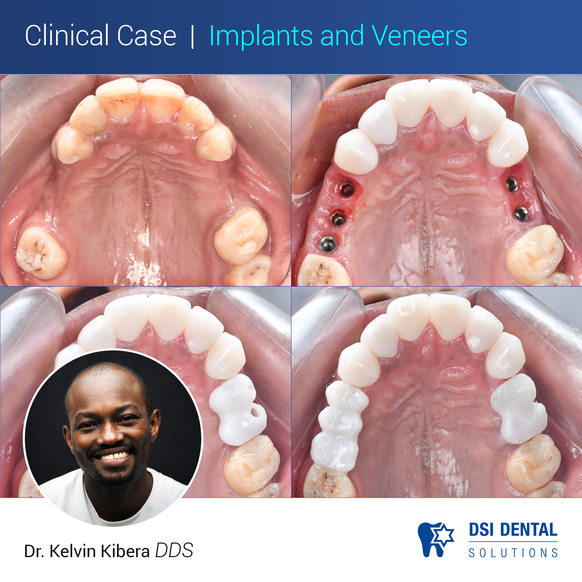 Case Study: Implants and Veneers Procedure. Anterior&Posterior ...
