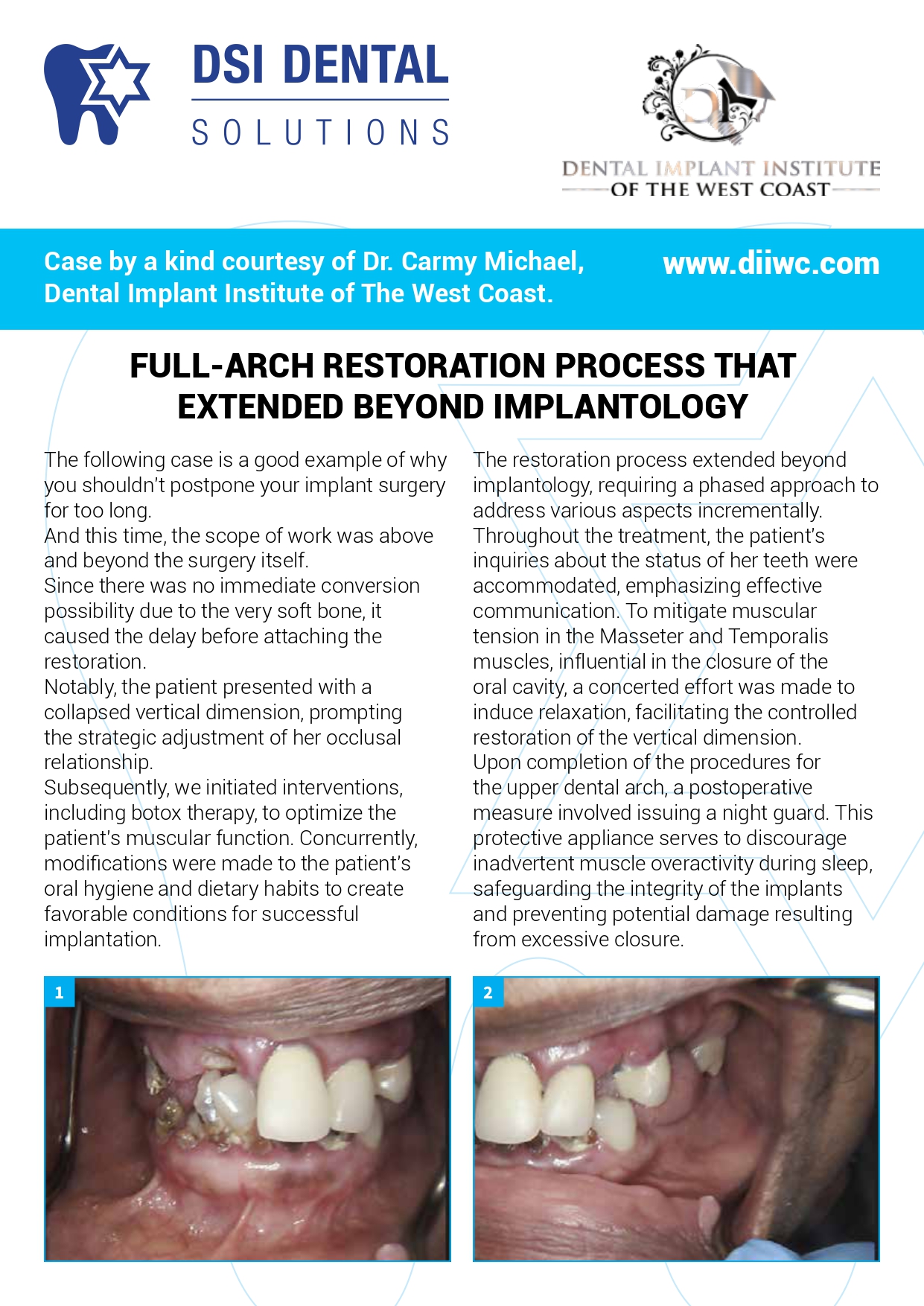 Case Study: FULL-ARCH RESTORATION PROCESS THAT EXTENDED BEYOND ...