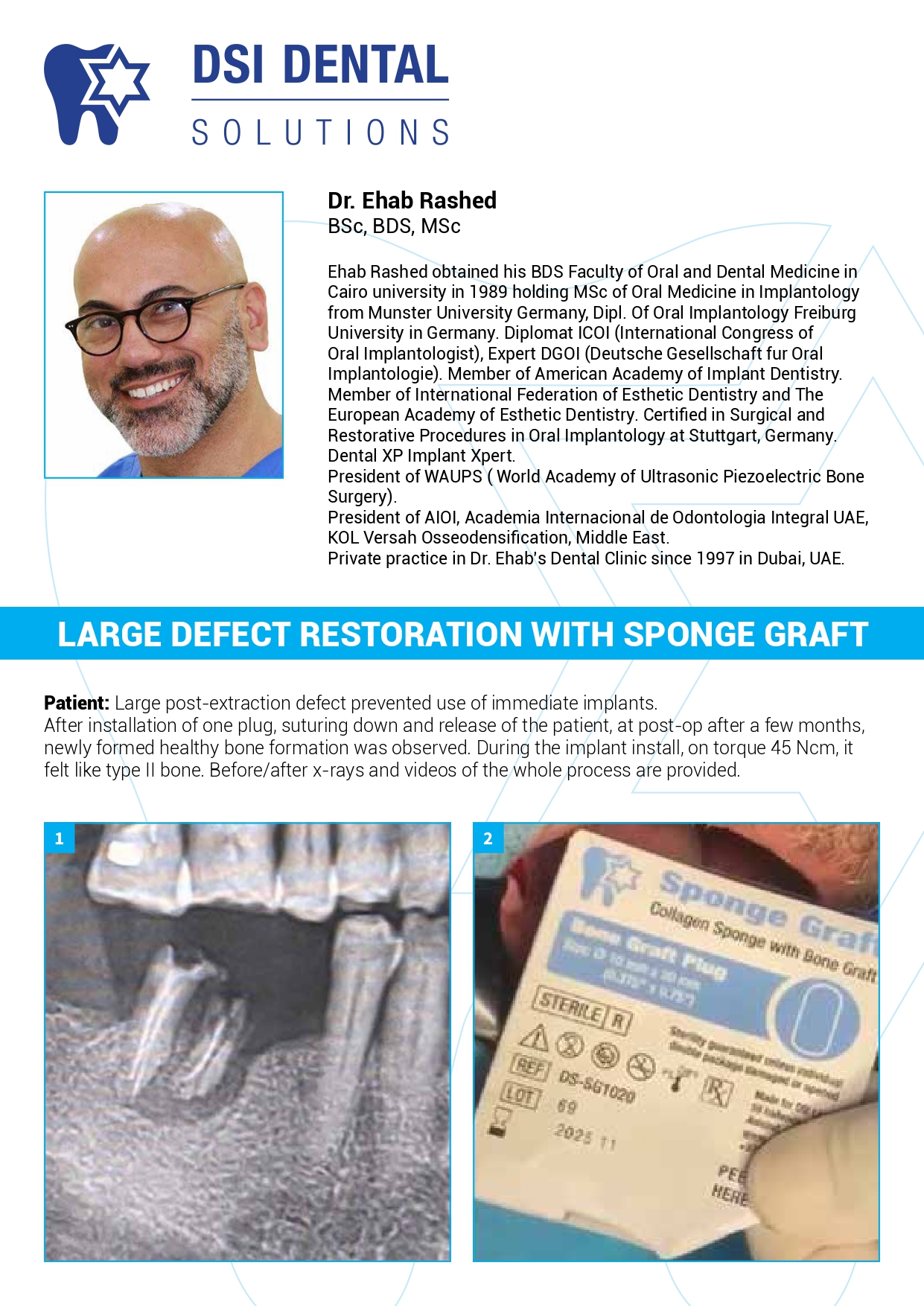 Case Study: Large Defect Restoration With DSI Sponge Graft | DSI