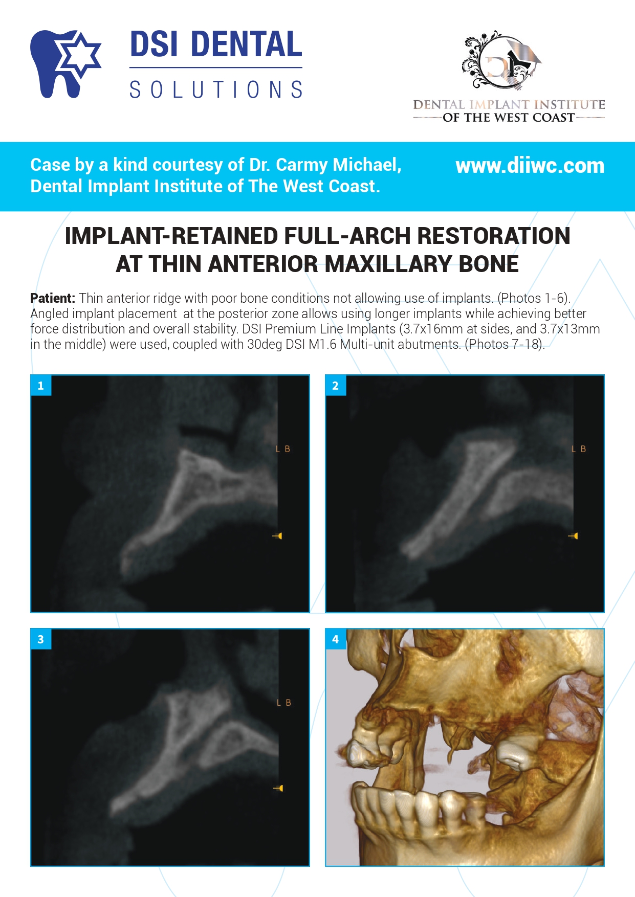 Case Study: Implant-Retained Full-Arch Restoration At Thin Anterior ...