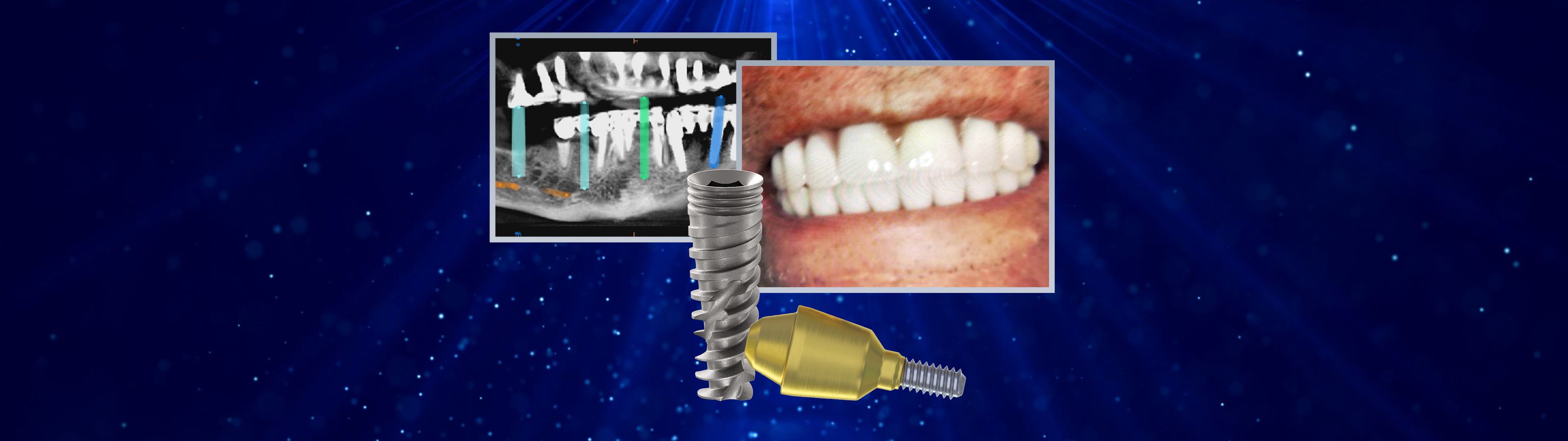Case Study: Full-Mouth Implant Makeover | DSI