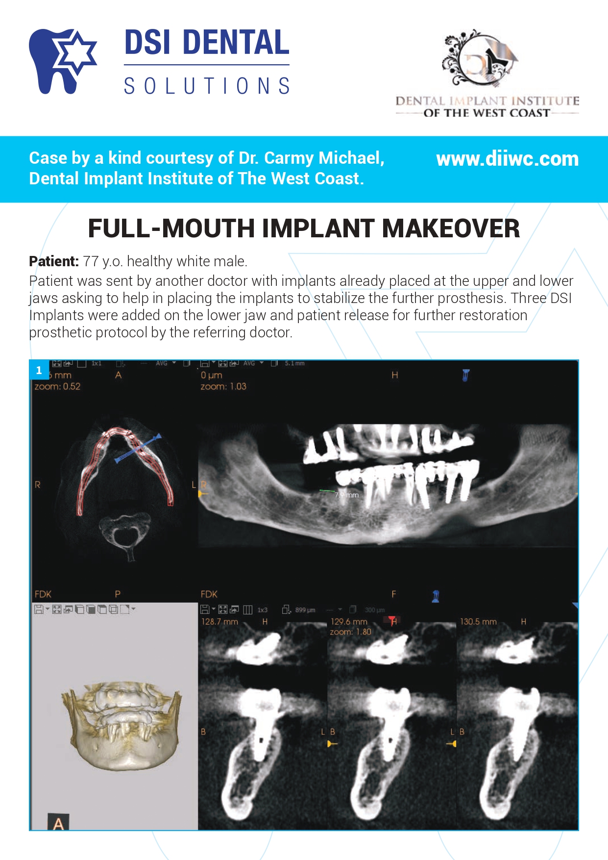 Case Study: Full-Mouth Implant Makeover | DSI