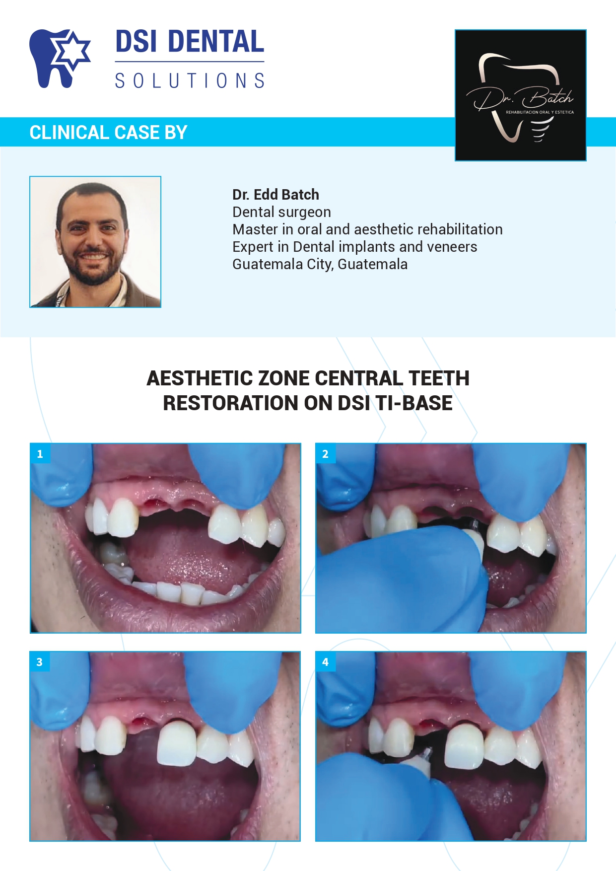 Case Study: Aesthetic Zone Central Teeth Restoration on DSI Ti-Base | DSI
