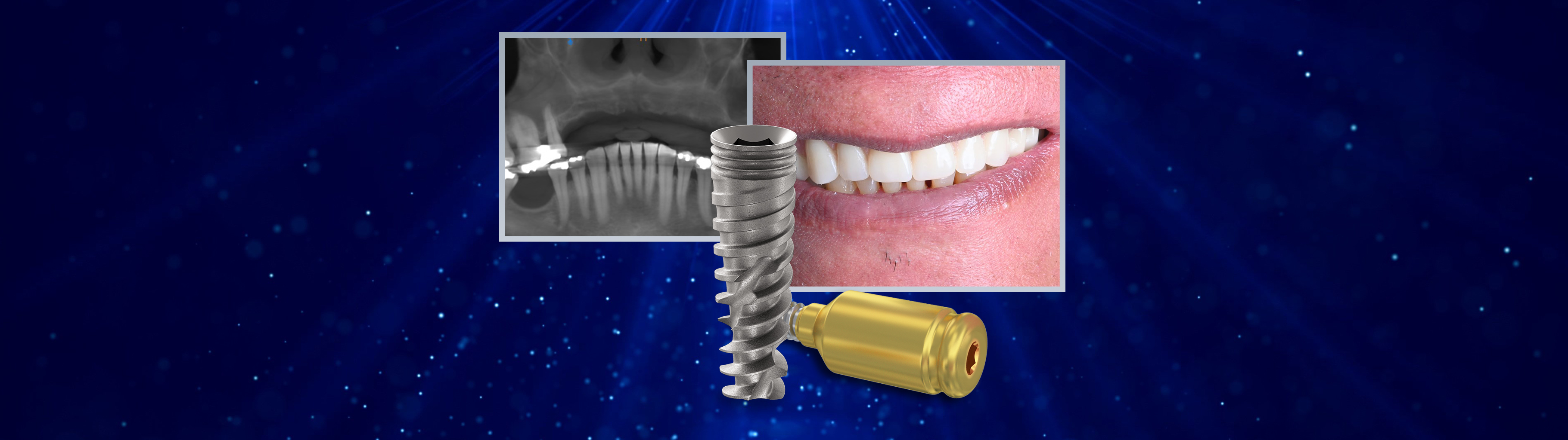 Case Study: Removable Partial Denture Using Implant-Supported Loc-In ...