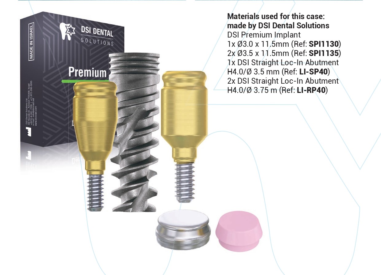 Case Study: Removable Partial Denture Using Implant-Supported Loc-In ...