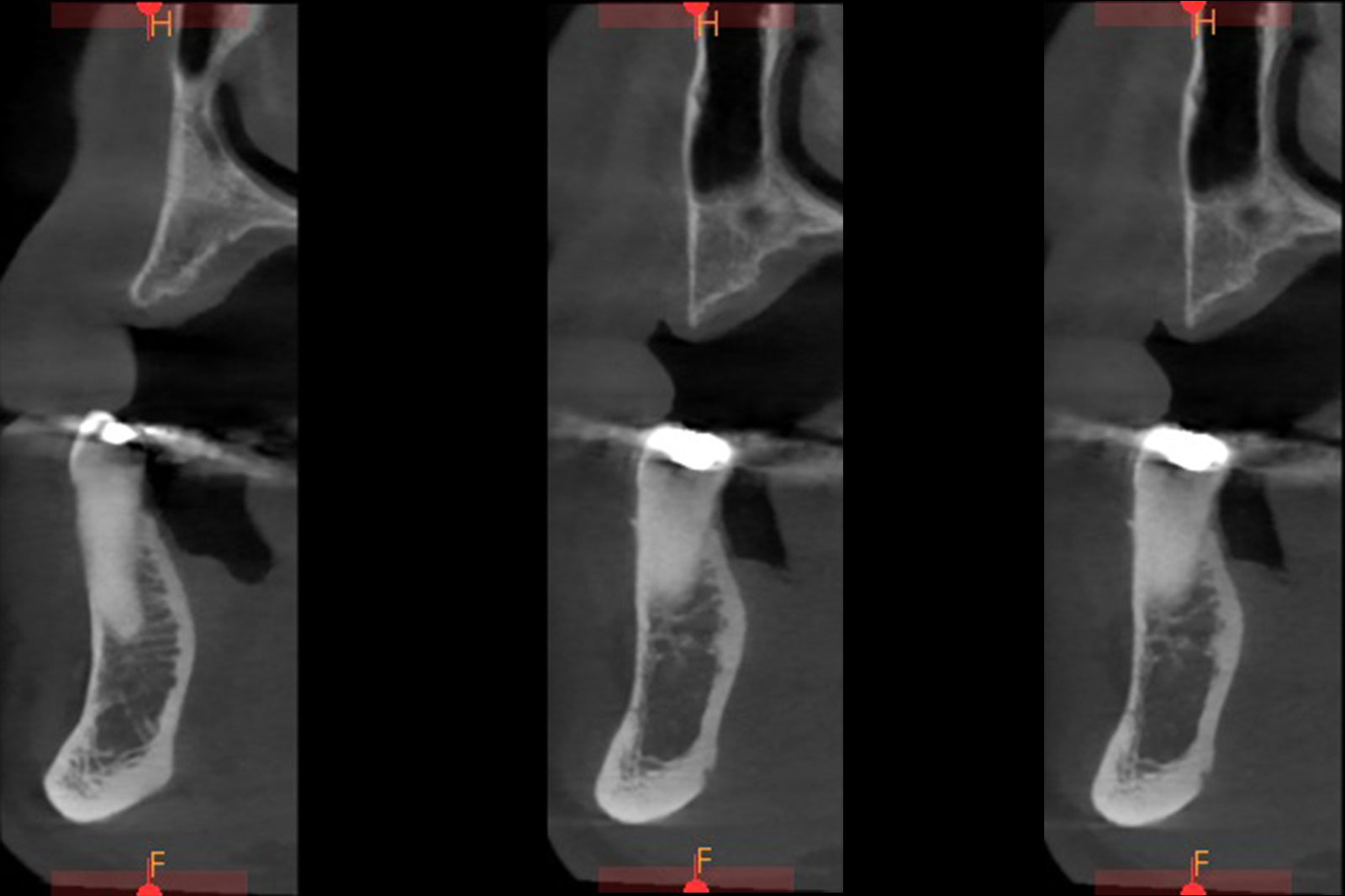 Case Study: Removable Partial Denture Using Implant-Supported Loc-In ...