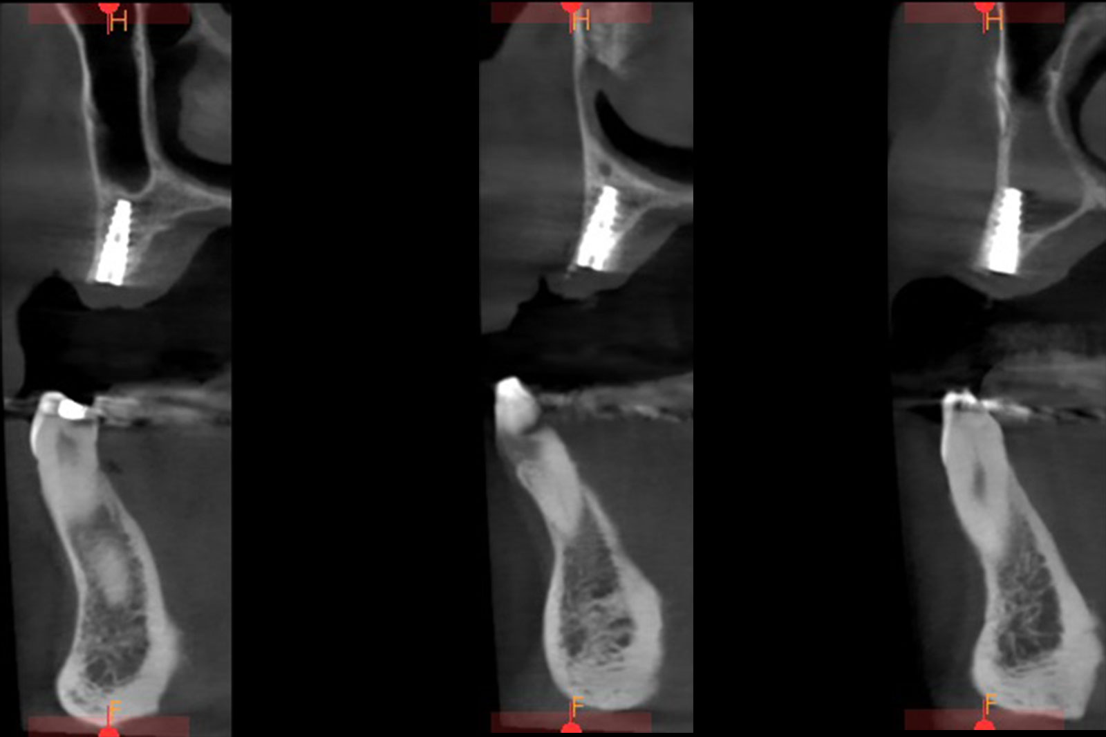 Case Study: Removable Partial Denture Using Implant-Supported Loc-In ...