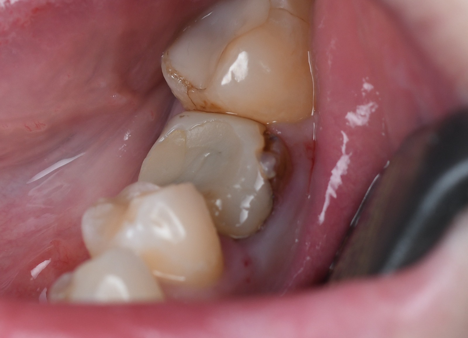 Case Study: Sealing Socket Abutment Technique - Immediate Implant ...