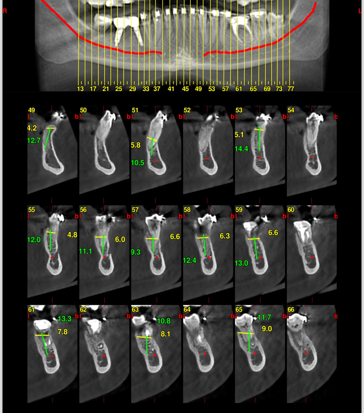 Case Study: Sealing Socket Abutment Technique - Immediate Implant ...