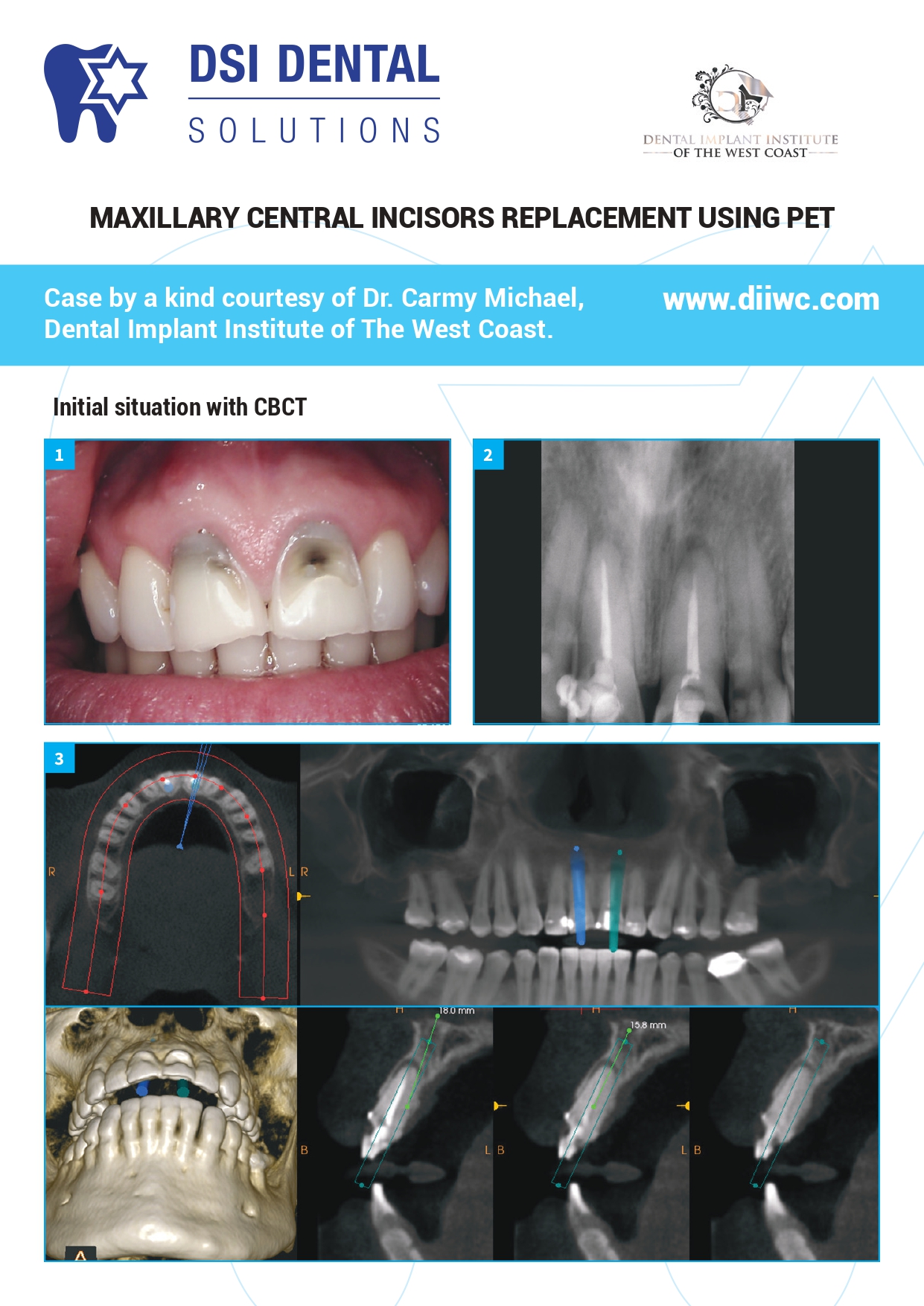 Case Study: MAXILLARY CENTRAL INCISORS REPLACEMENT USING PET | DSI