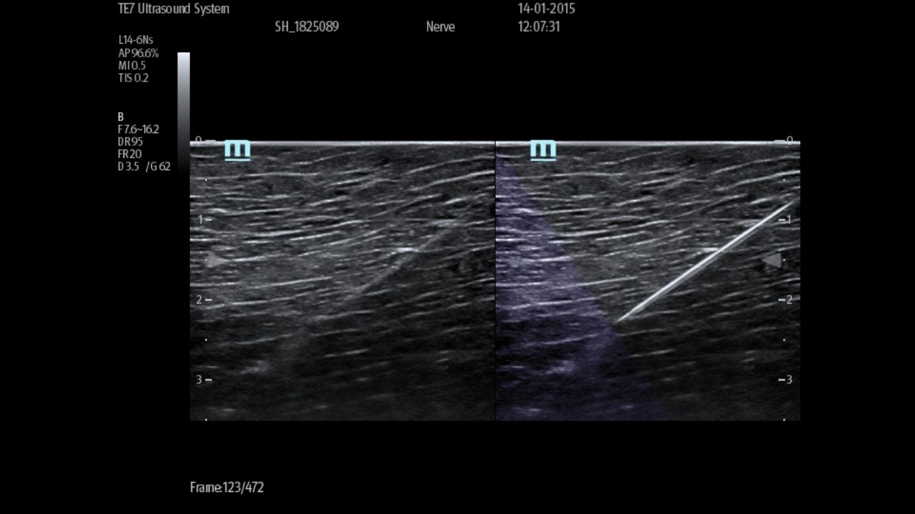 Mindray TE5 - Ultrasound System | Biomed Plus