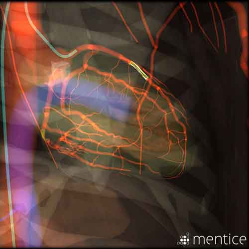 Mentice Showcases Coronary Training Solution at IMSH 2020 | Mentice Blog