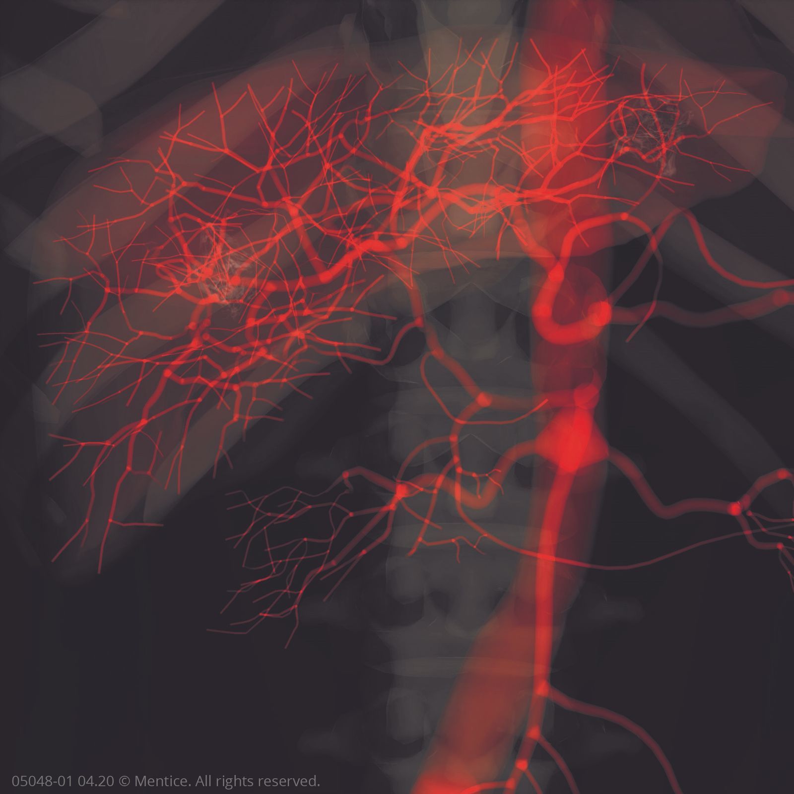 Transarterial Chemoembolization | Software