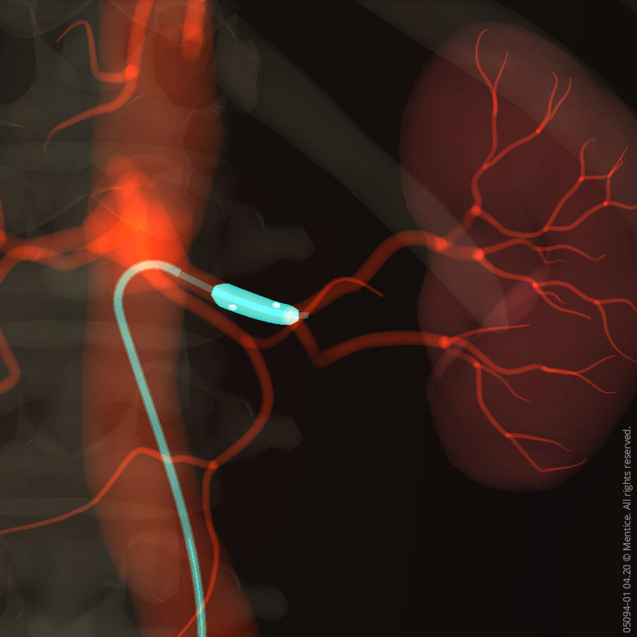 Renal Denervation | Software