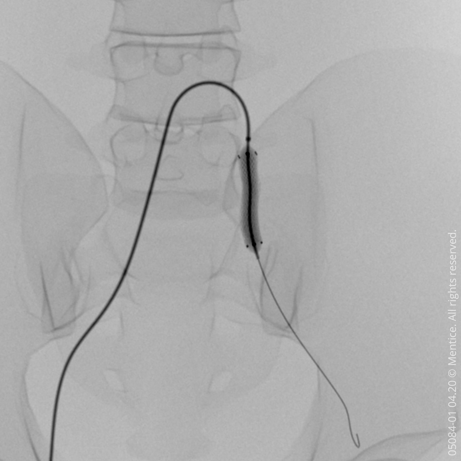 Iliac and SFA Intervention | Software
