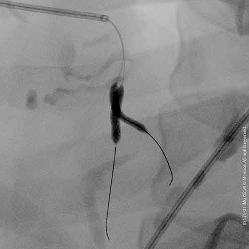 Virtual Reality endovascular simulators