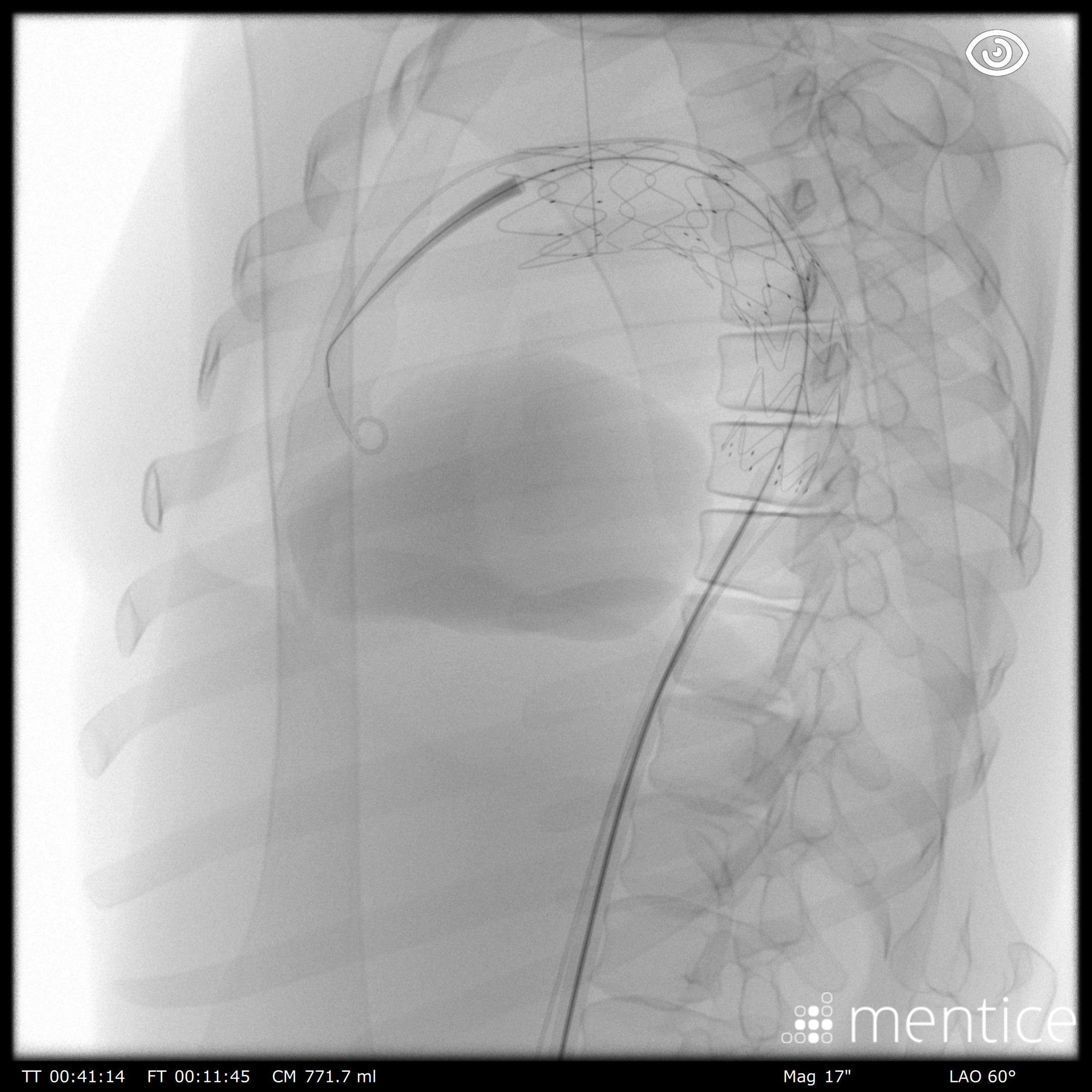 Thoracic Endovascular Aortic Repair | Software