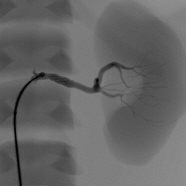 Renal Intervention | Software