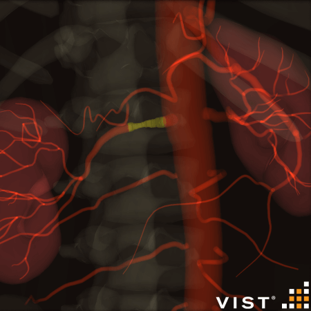 Renal Intervention | Software
