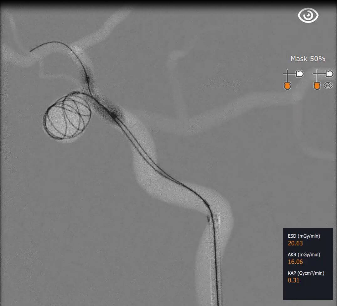 Neurovascular Coiling | Software