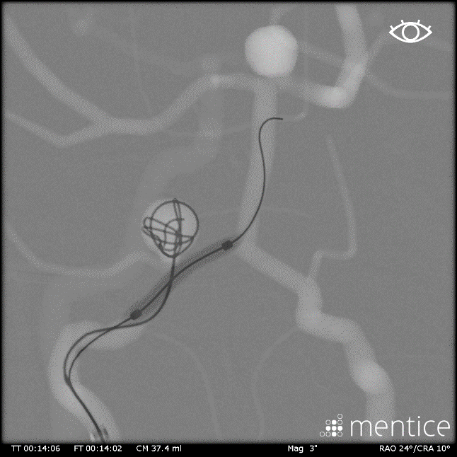 Neurovascular Coiling | Software