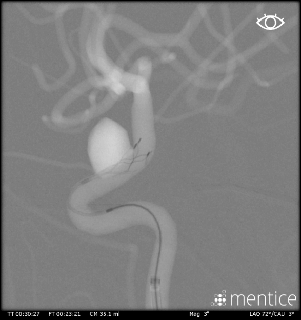 Neurovascular Coiling | Software