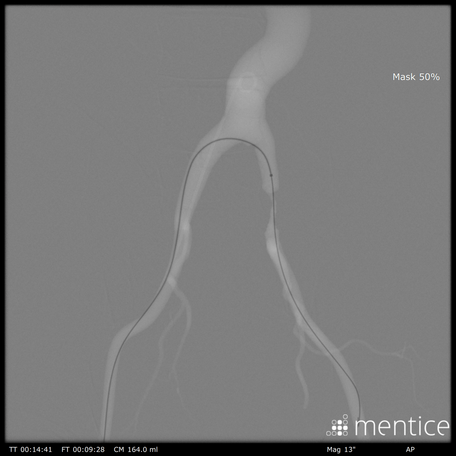 Iliac and SFA Intervention | Software