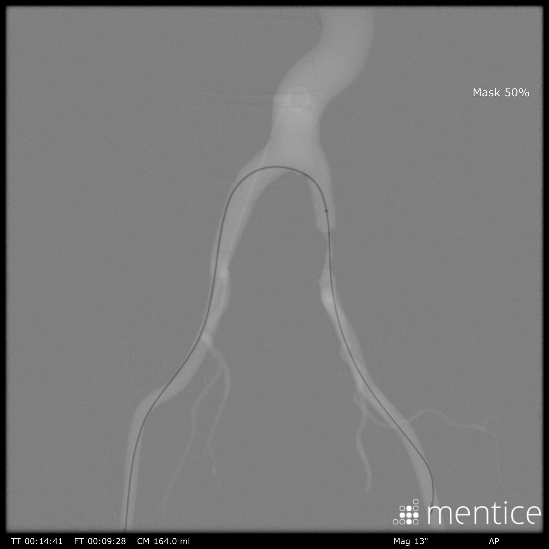 Iliac and SFA Intervention | Software