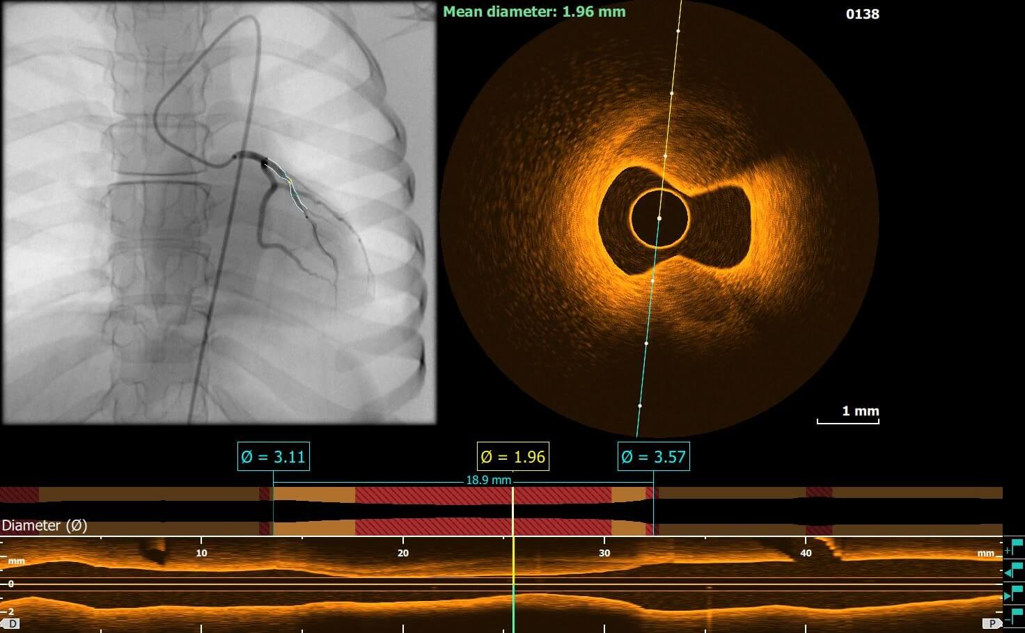 Coronary Intermediate | Software