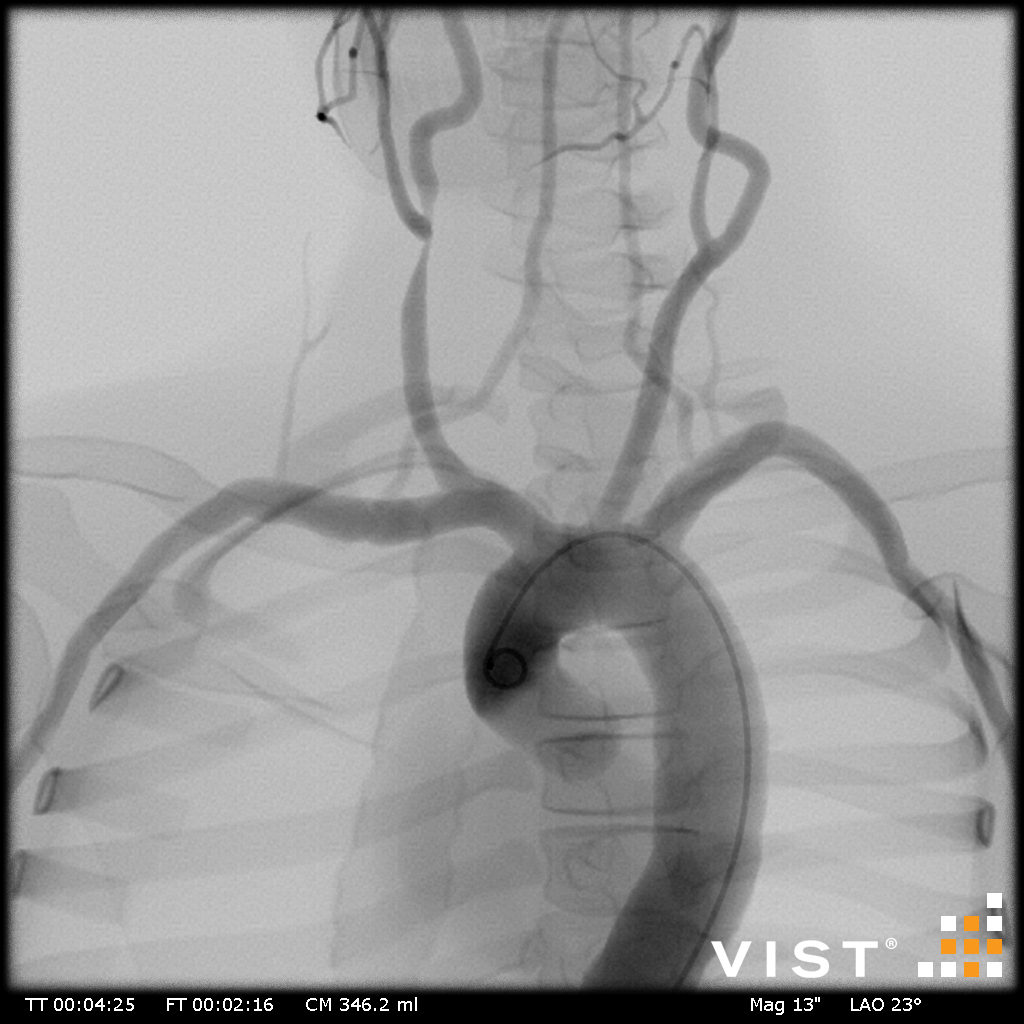 Carotid Intervention | Software