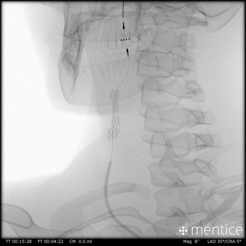 Carotid Intervention | Software
