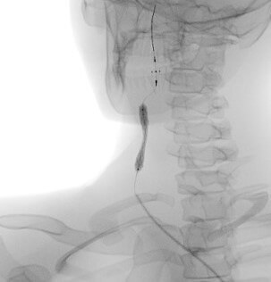Carotid Intervention | Software
