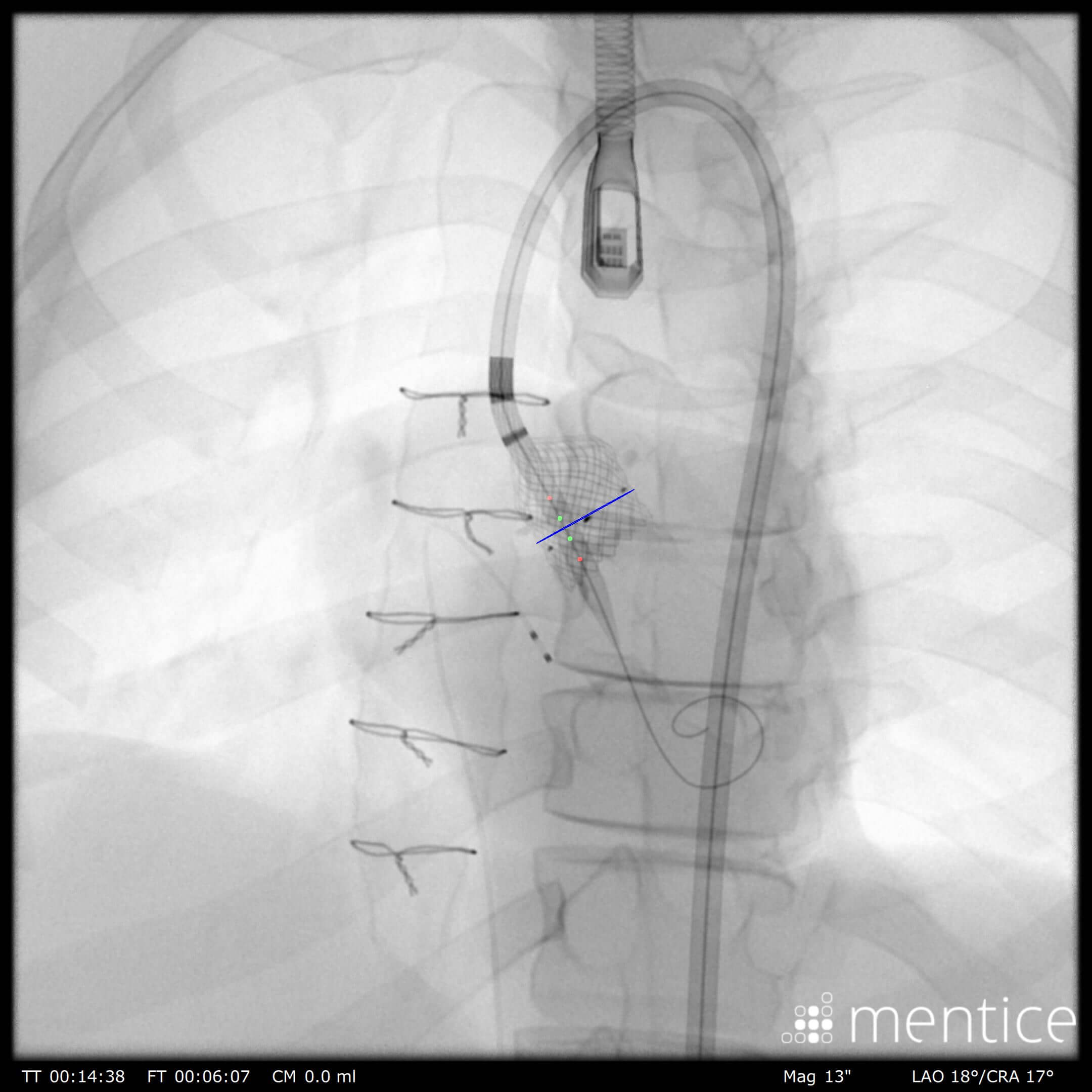 Aortic Valve Implantation | Software