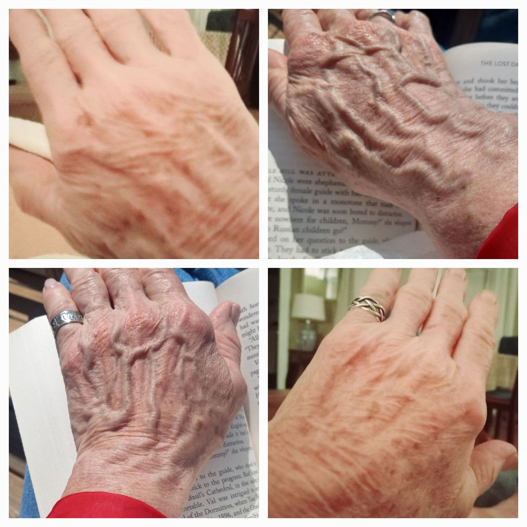 Hand Veins - - Atlantic Vein Institute, Newburyport, MA