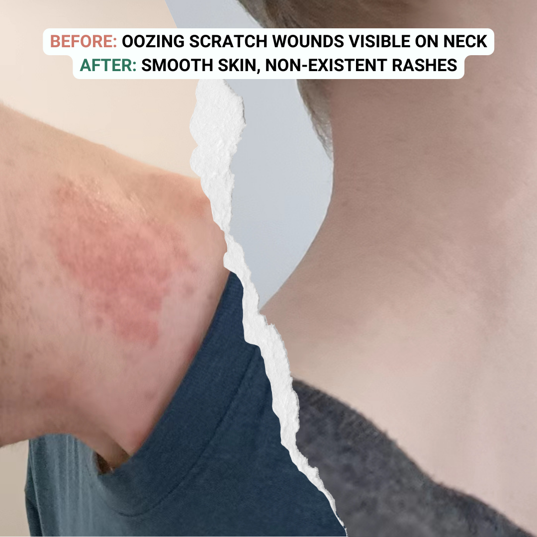 Success Story: How Teacher Peter Overcame Worst Nightmare Facial Eczema