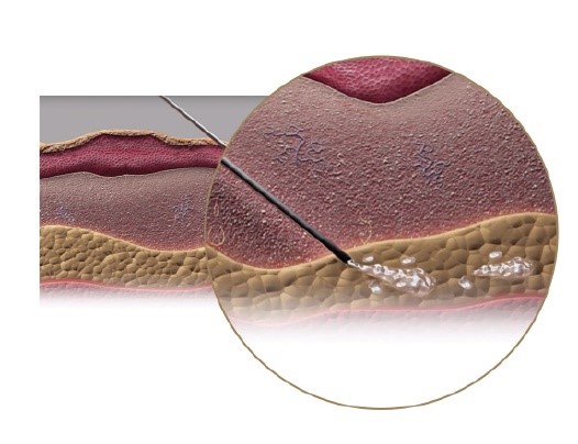 What is ATT? | Genefill