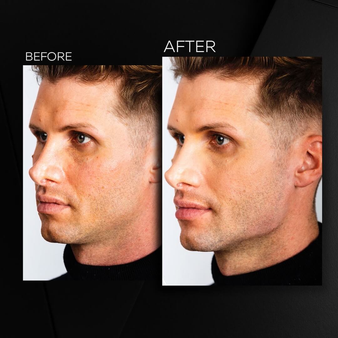 Genefill | The New Generation of Hyaluronic Acid Dermal Fillers